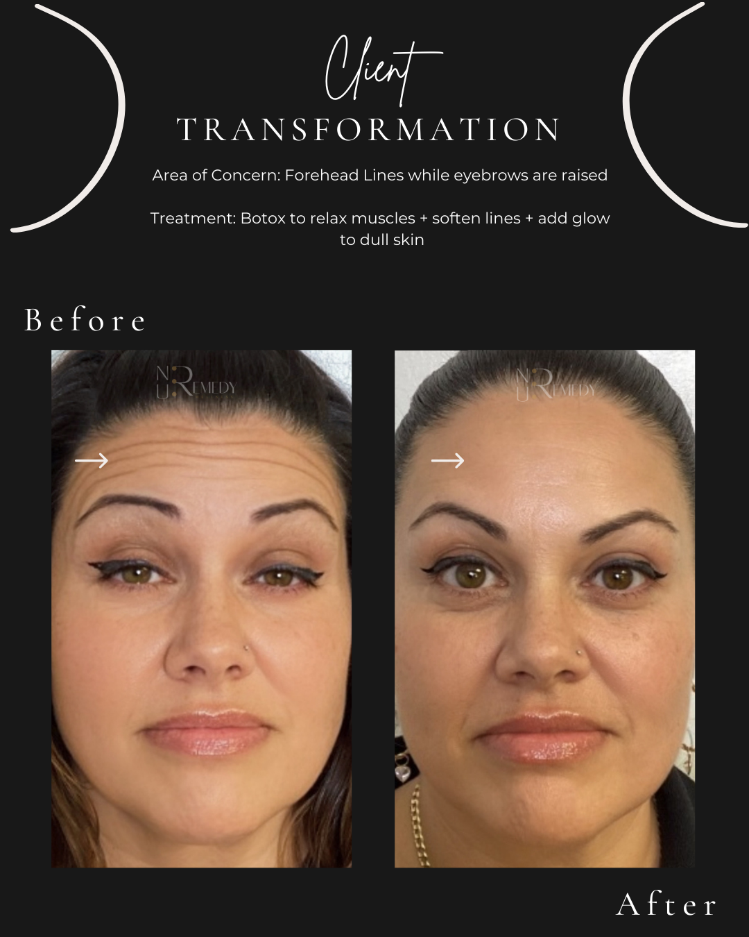 Botox – Nu Remedy Wellness – Medical Weight Loss, Botox & Fillers, IV ...